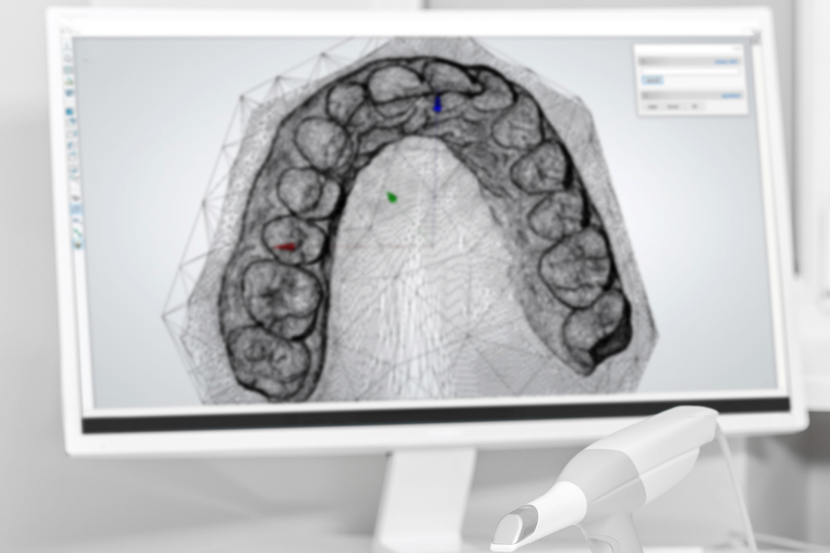 3D Printing in Dental Laboratories: Digital Dental Impressions
